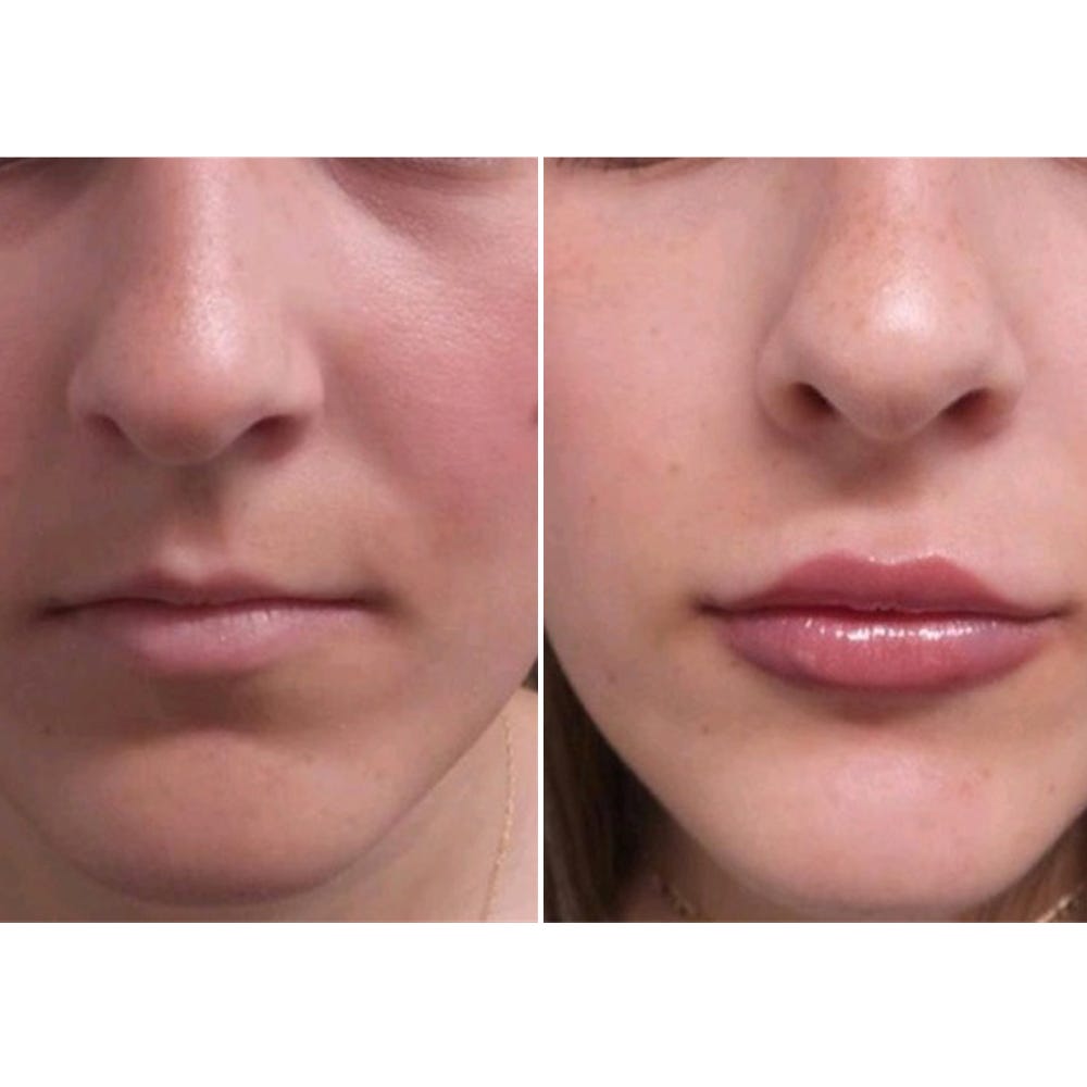 DERMAL FILLERS. Dermal fillers are used as the tools… | by lip doctor ...