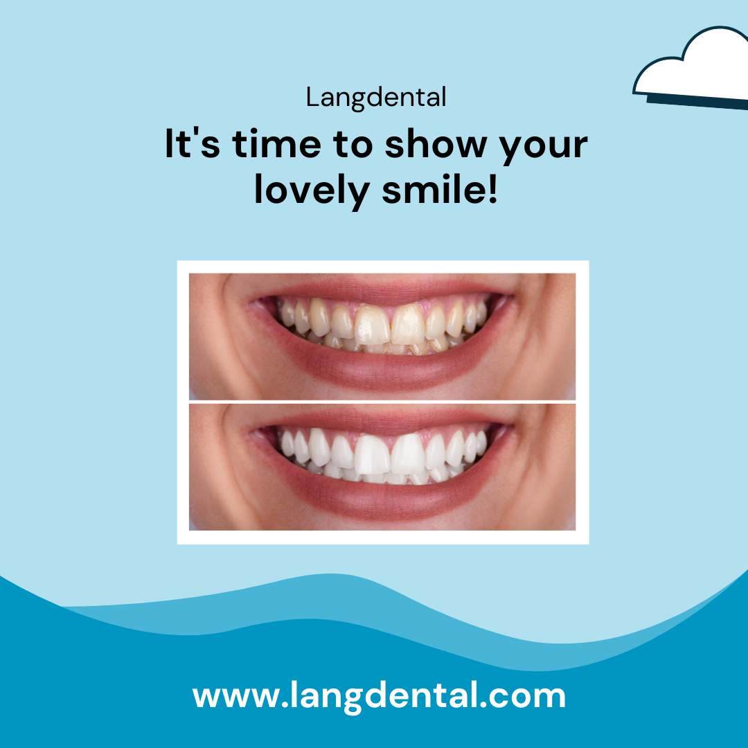 Enhance Smile with Colored Retainers and Pressure Pot Parts | by ...