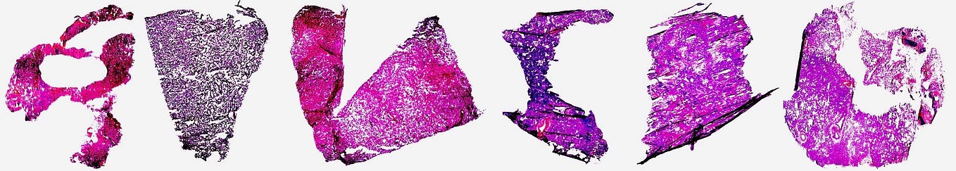 Using Generative Adversarial Networks Gans For Data Augmentation In Colorectal Images By