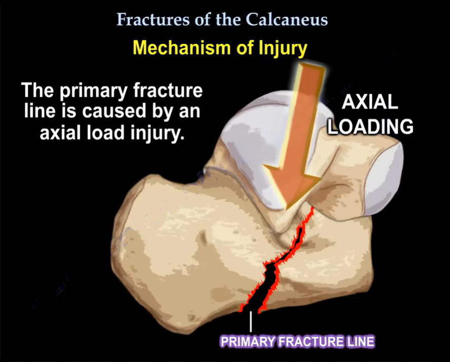 Sacral Sparing. Sacral sparing tests can be used to… | by Nabil ...