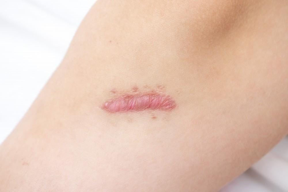 How to Properly Extract Pimples. Having pimples on your face or body ...