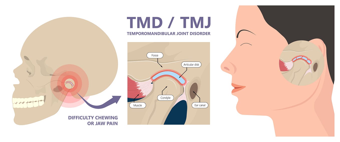 What Is The Newest Treatment For TMJ? | by ICCMO | Jun, 2024 | Medium