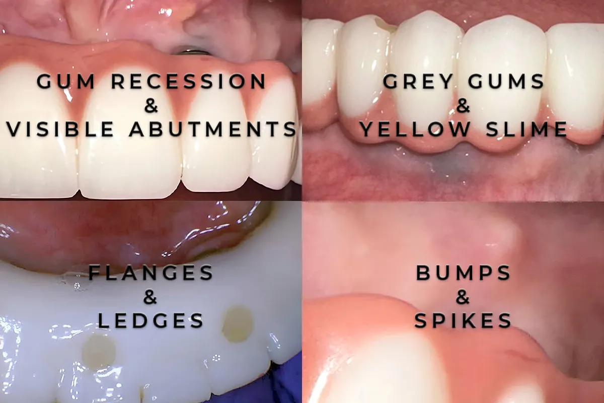 Bait and Switch in Antalya: My Dentatur All-On-8 Experience | by ...