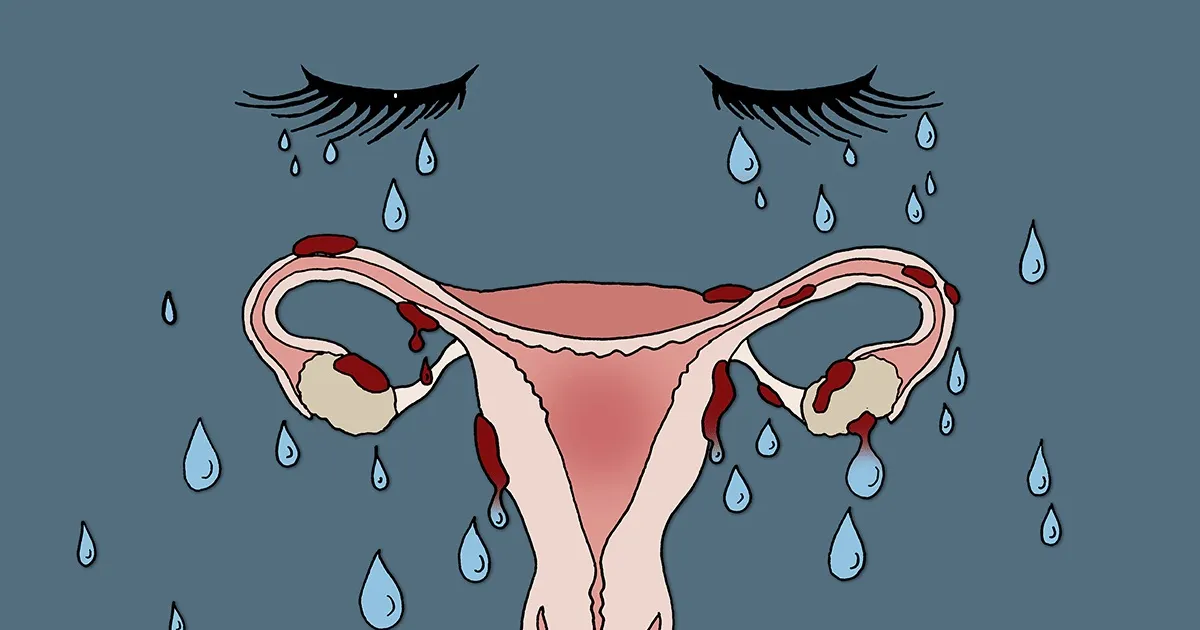 Endometriosis is a chronic condition where tissue similar to the lining ...