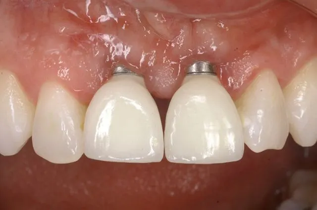 Tooth infection under the dental porcelain veneers | by Hussain Al ...