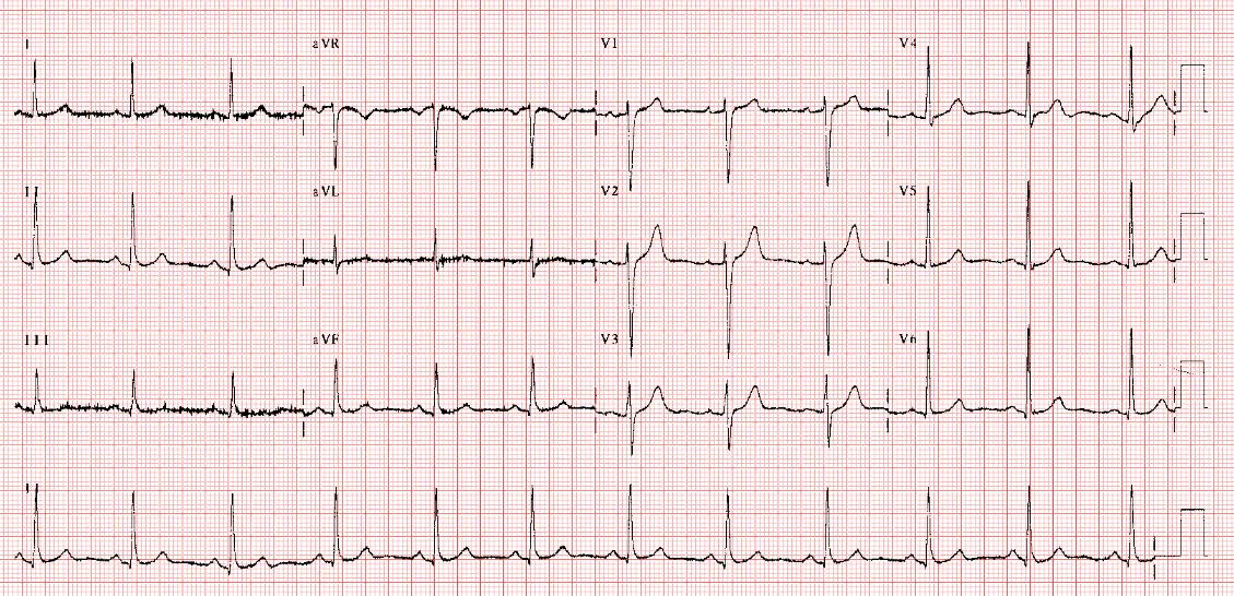 Pan-Tompkins Algorithm for Detecting QRS Waves | by Cosmic Wanderer | Medium