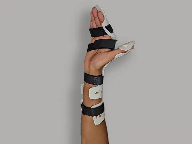 The Evolution of Splinting: From Ancient Techniques to 3D-Printed ...