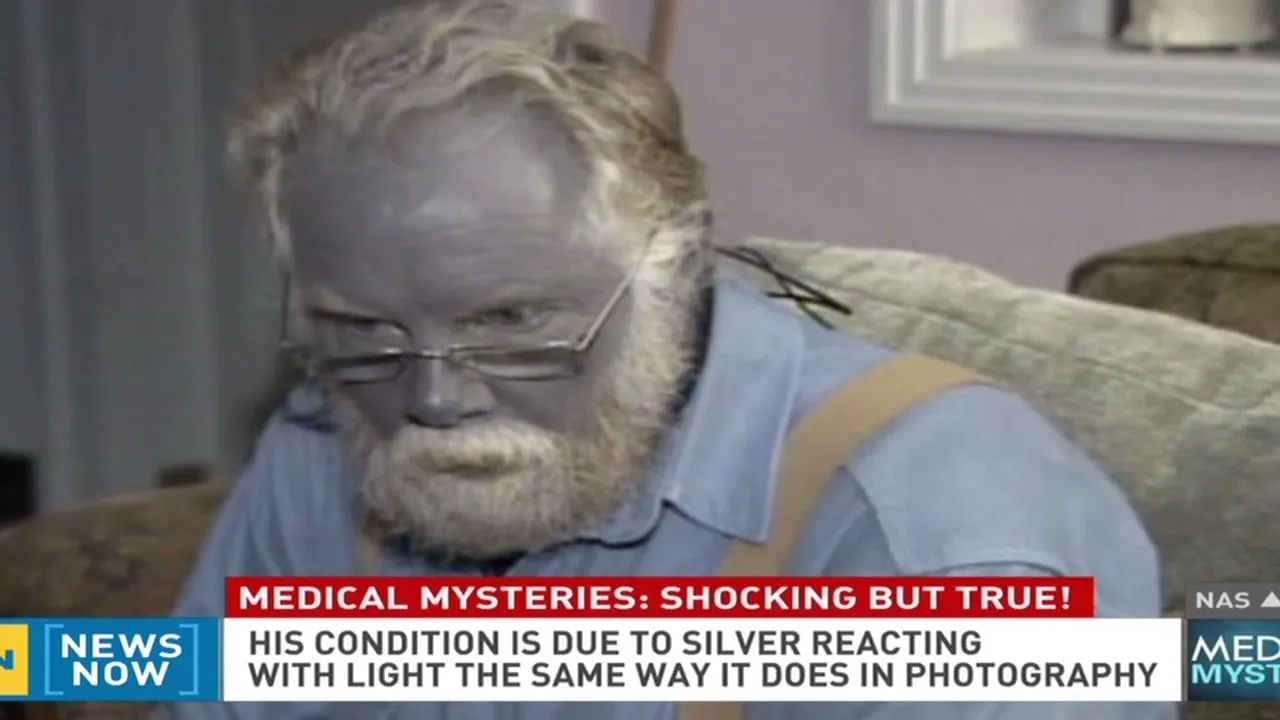 The Man Who Lived Without a Pulse | by Medical Mysteries Uncovered ...