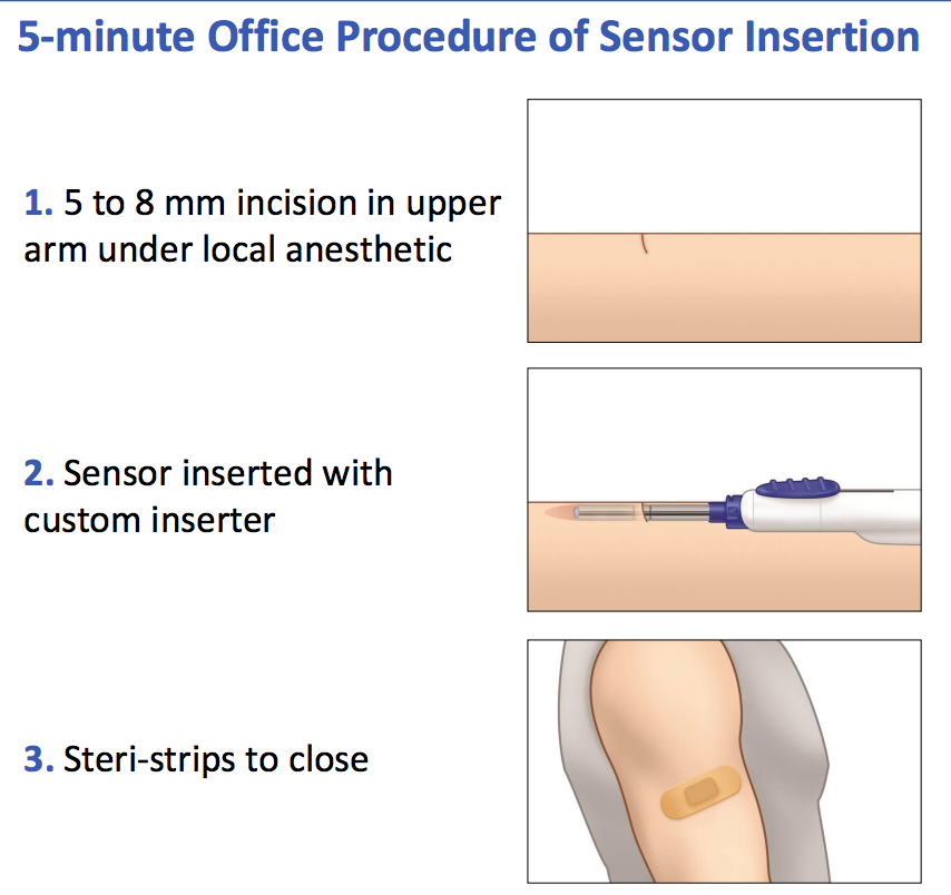 Eversense Implantable Glucose Senso Online | emergencydentistry.com
