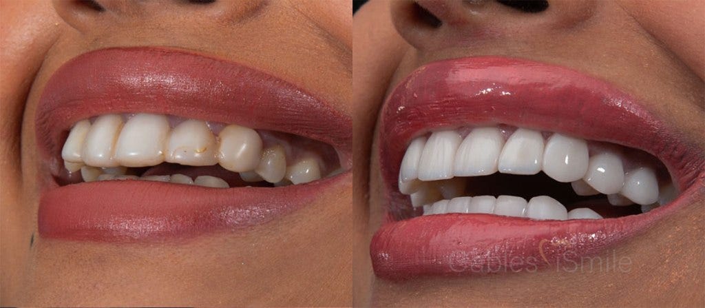 Glitz Photos Before And After