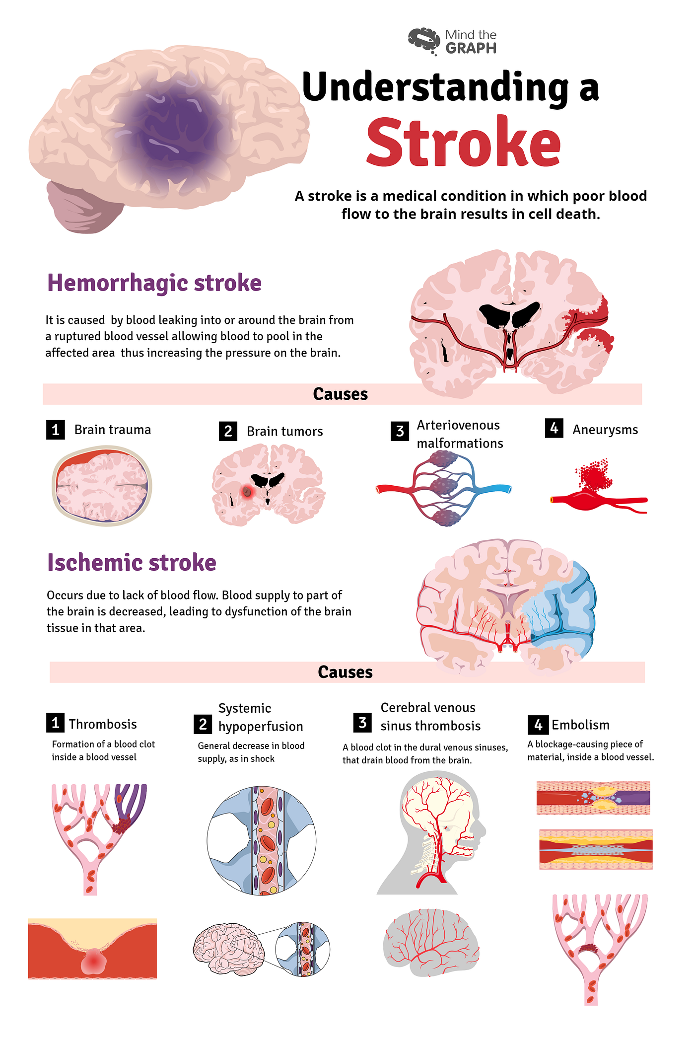 Stroke Symptoms Stroke Symptoms
