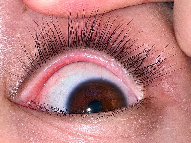 Double Row Eyelashes Mutation