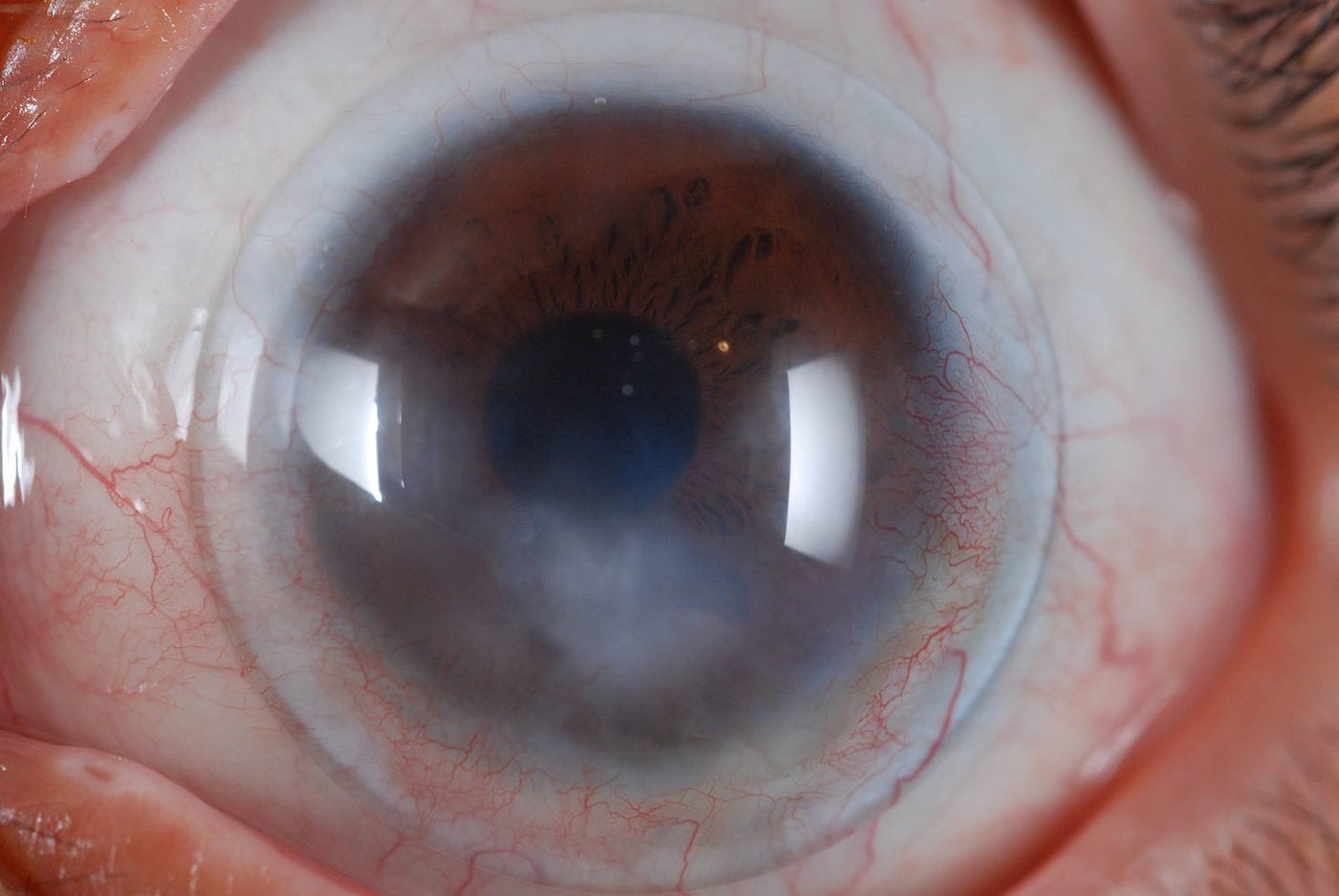 Cloudy Spot On Cornea