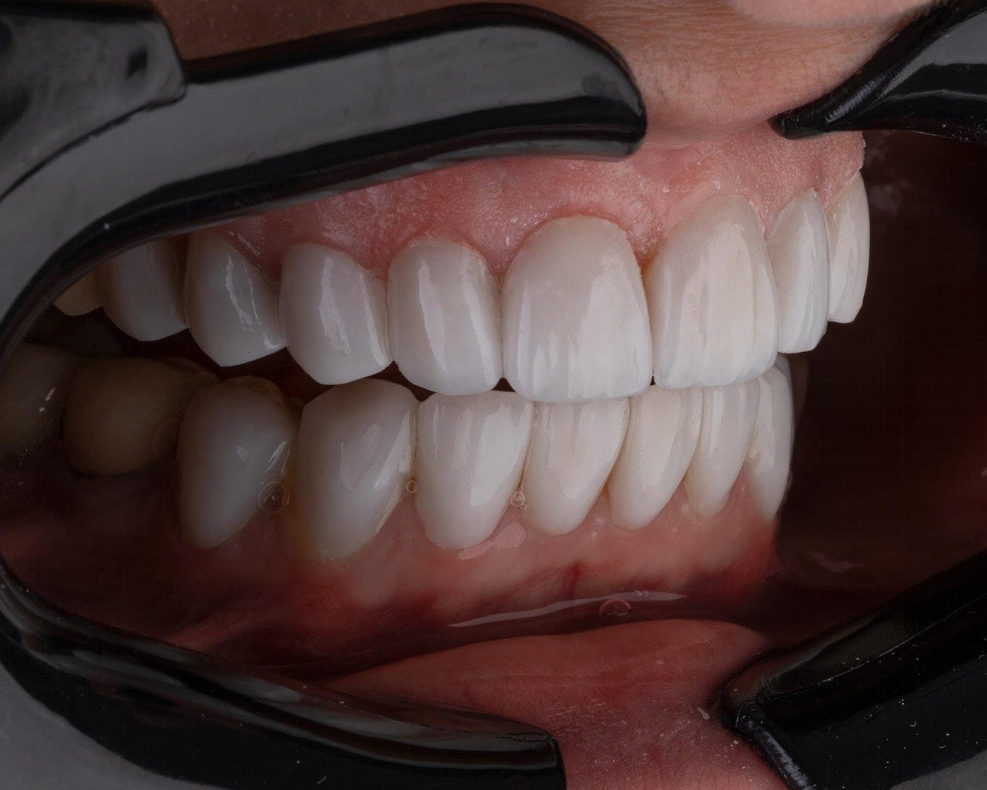 Calculus Teeth