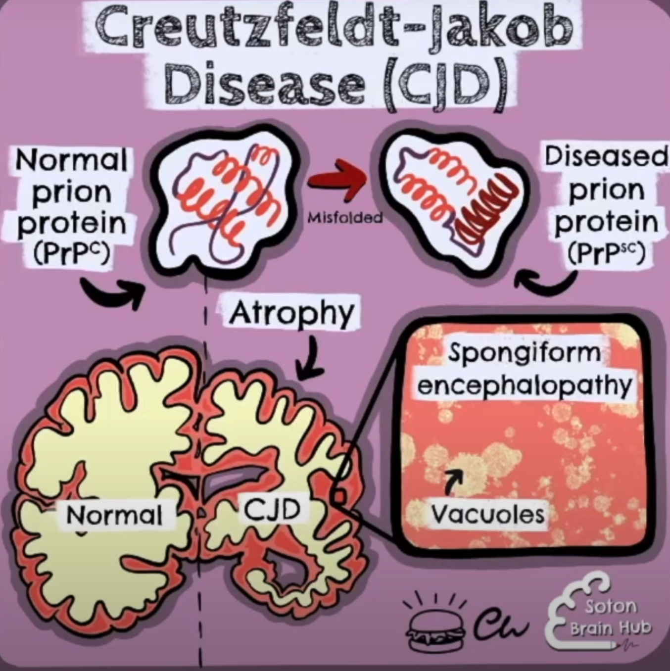Creutzfeldt Jakob Disease Brain