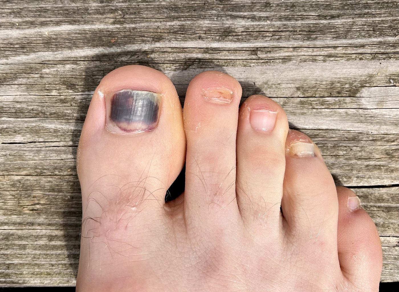 Black Toe Fungus