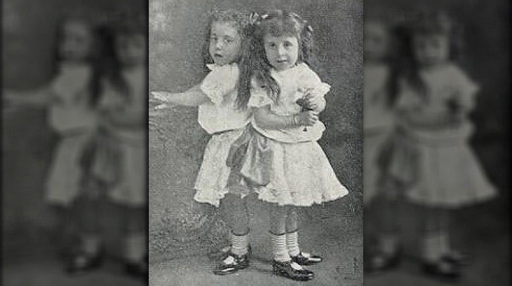Hamilton Sisters Siamese Twins