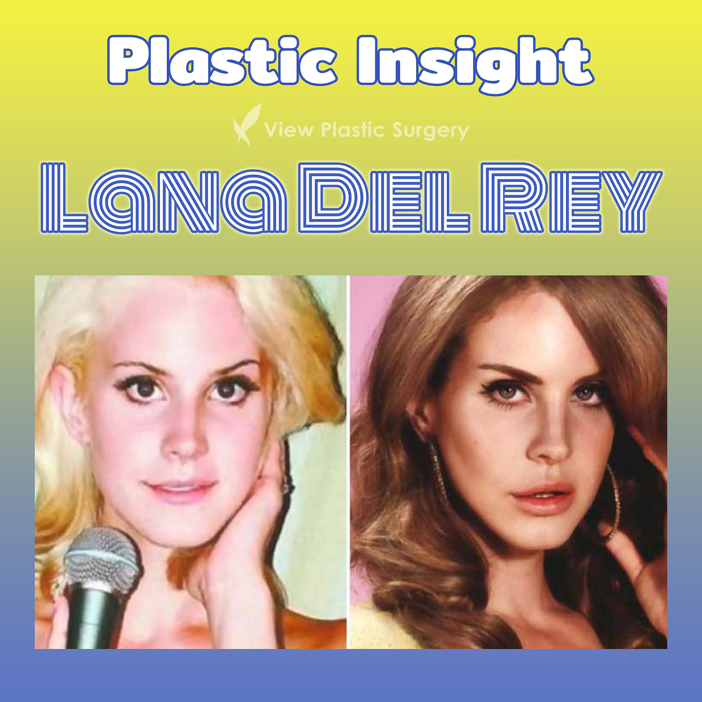 Lana Del Rey Before And After