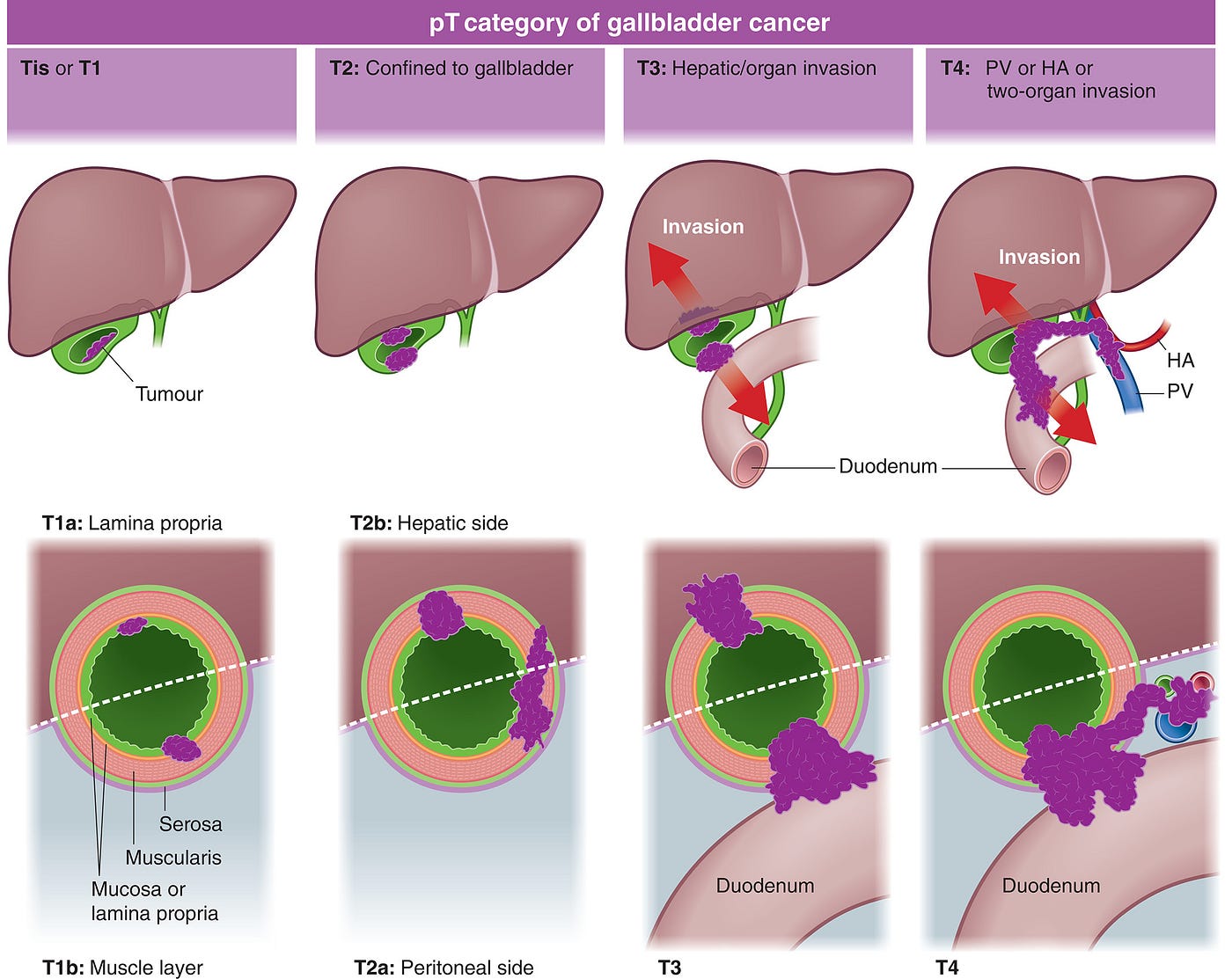 Muscularis Propria Cystic Duct