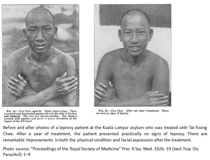 Leprosy Before And After Treatment