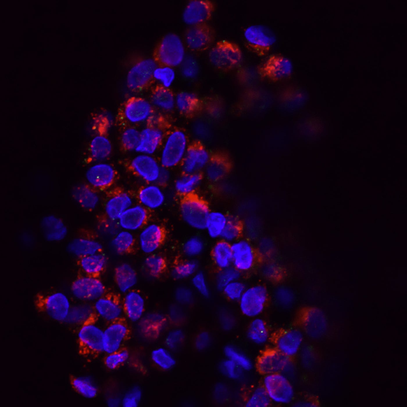 Breast Cancer Rcpath Dataset