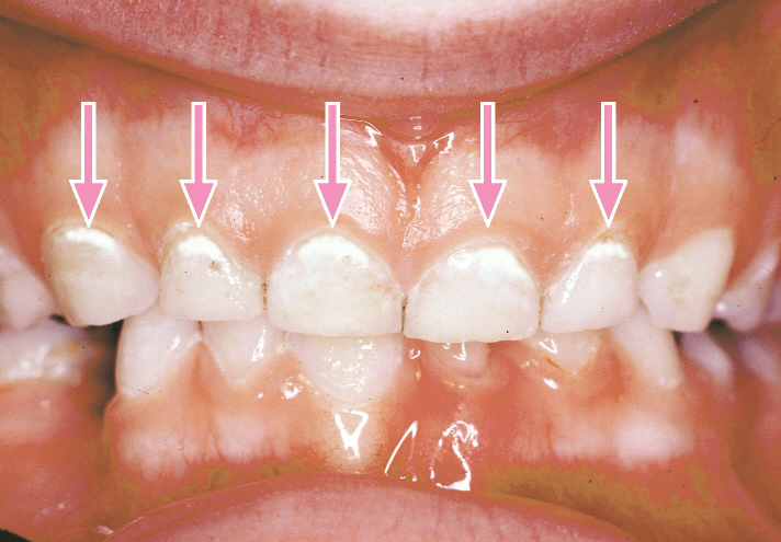 Bottle Caries