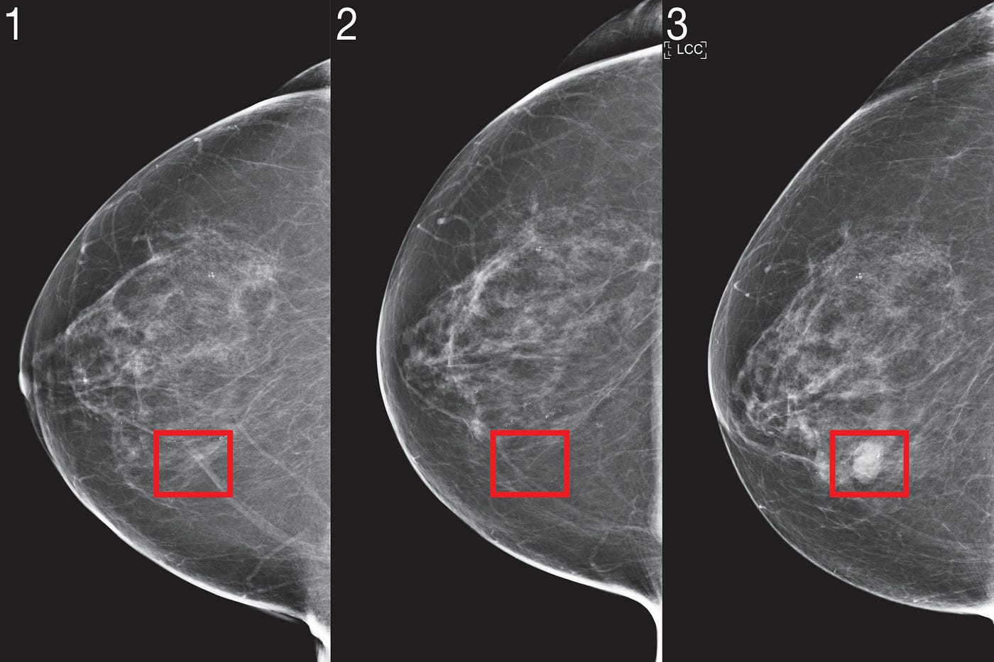 Breast Cancer Rcpath Dataset