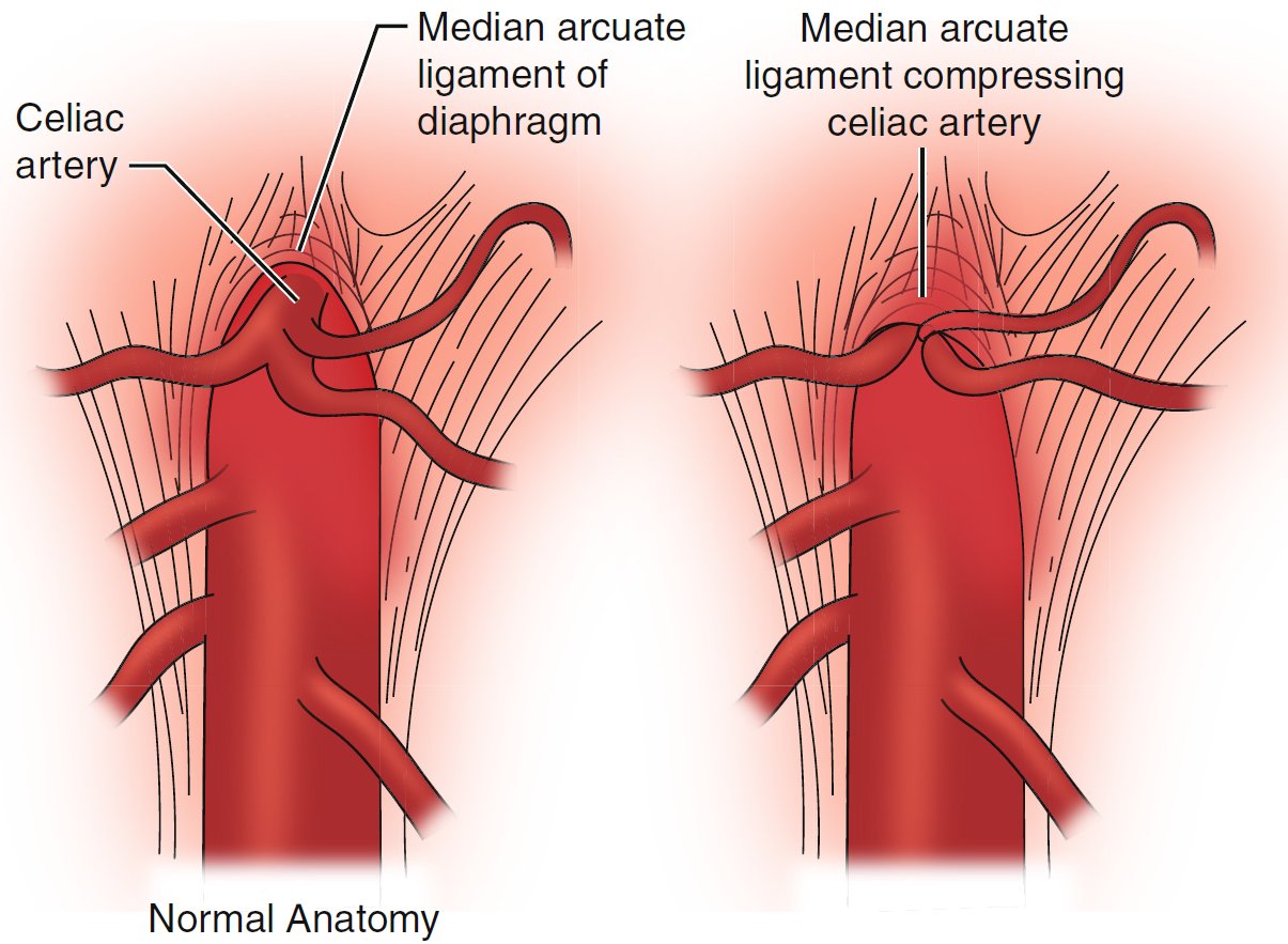 Arcuate Ligament Syndrome