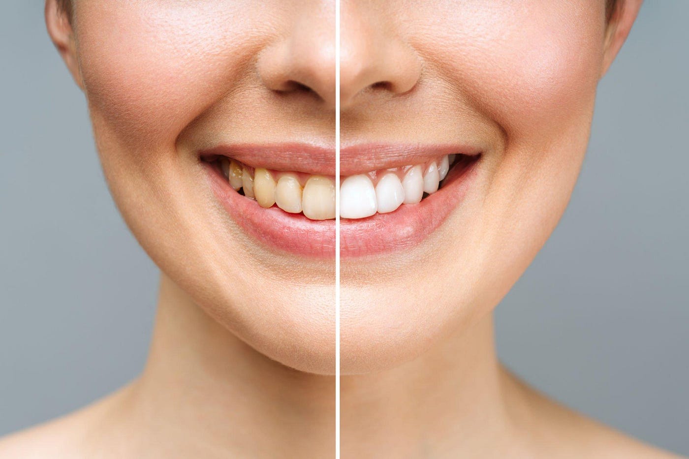 Whitest Teeth In The World