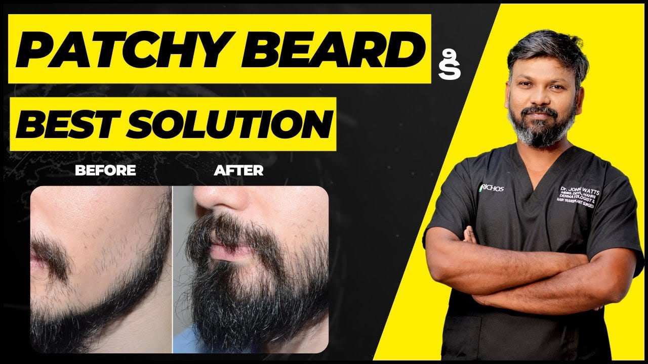Patchy Beard Before And After