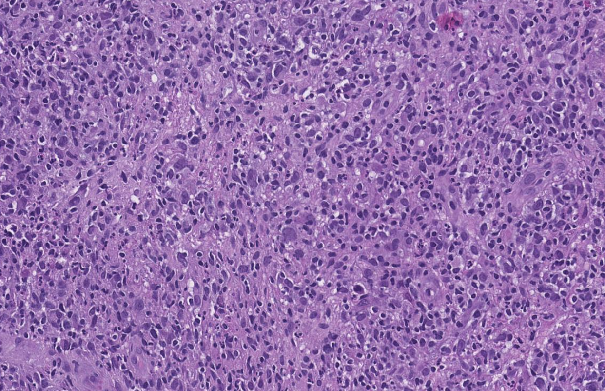 Lymphoma Cells In Suspension