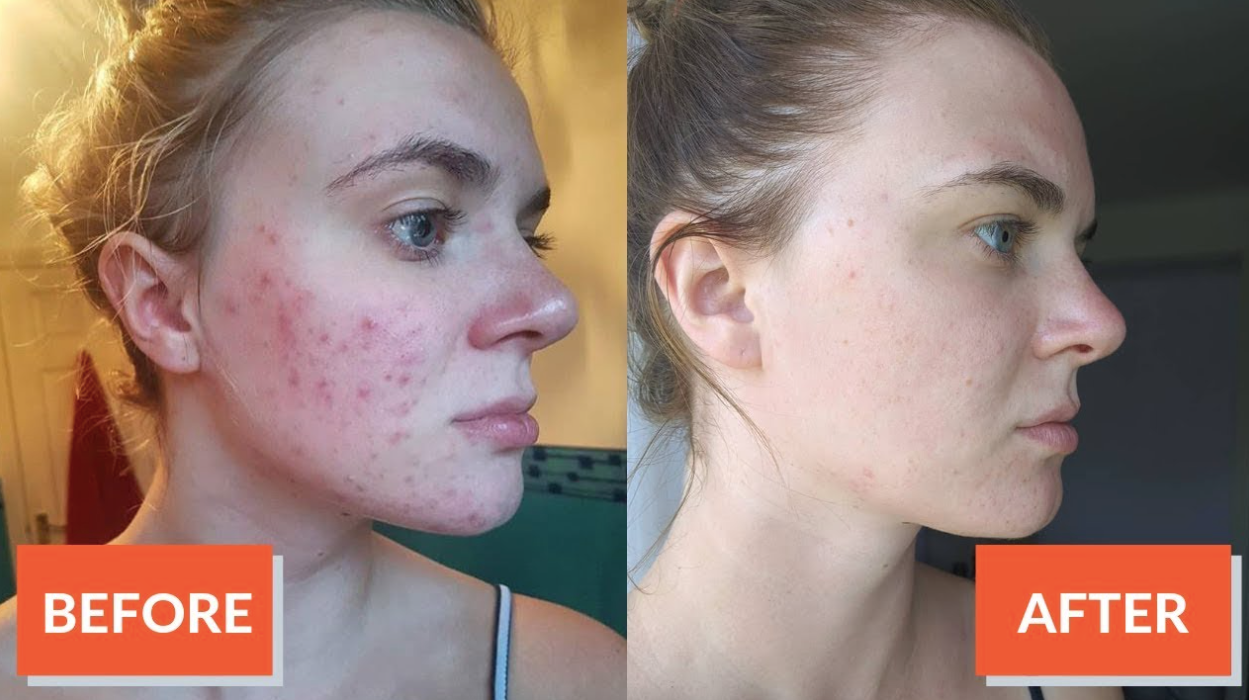 Retinol Can Dramatically Improve The Look of Your Face. Here s How by Samir S. An Idea by Ingenious Piece Medium