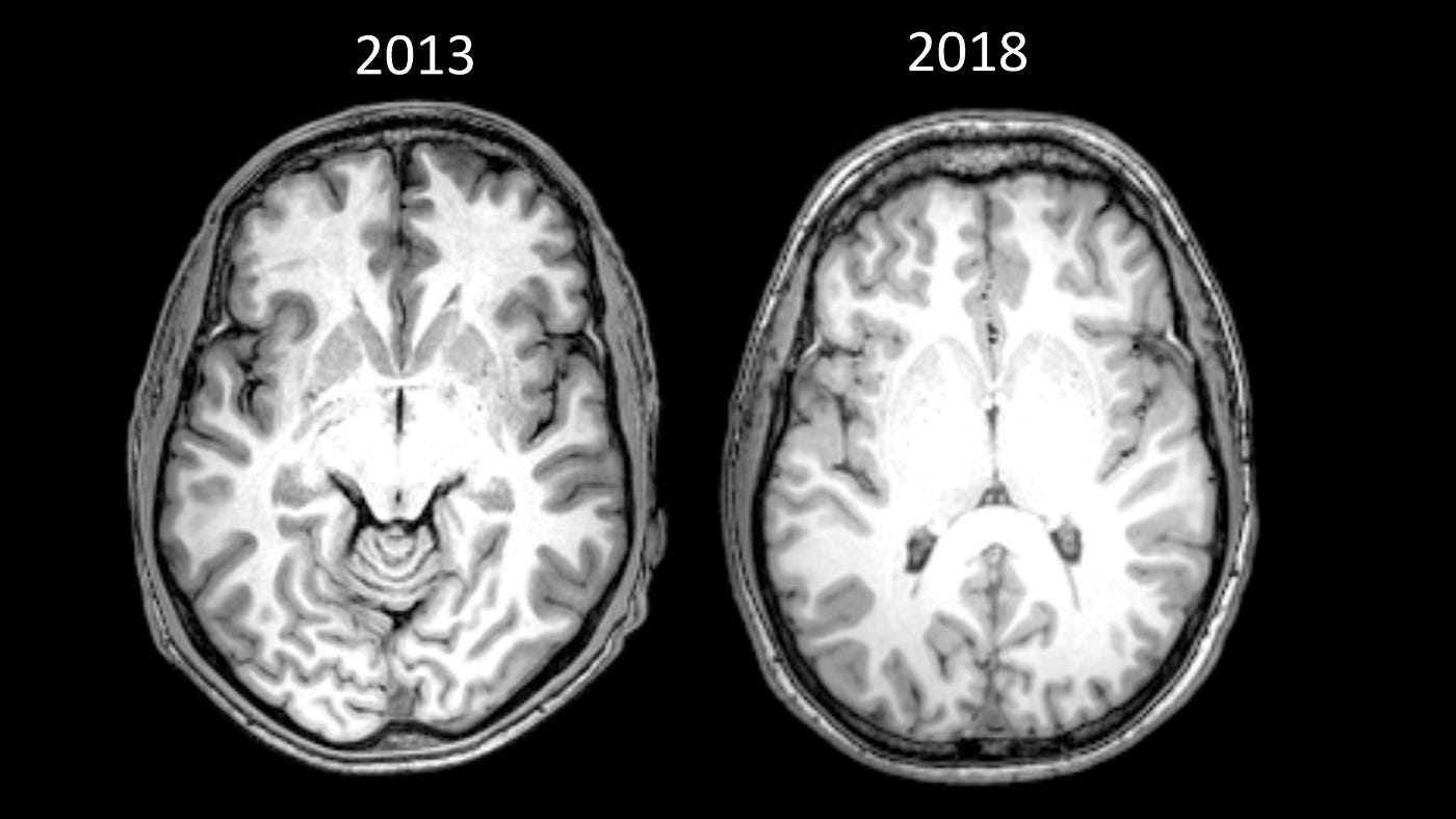 Mindfulness Brain Mri