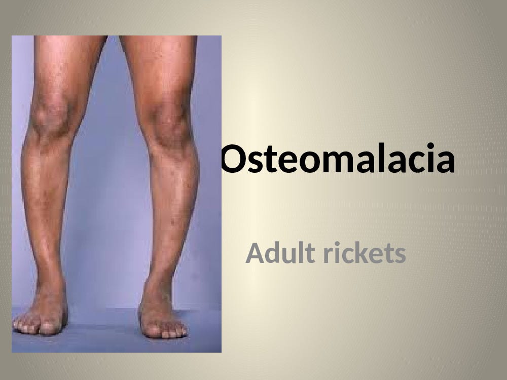 People With Osteomalacia