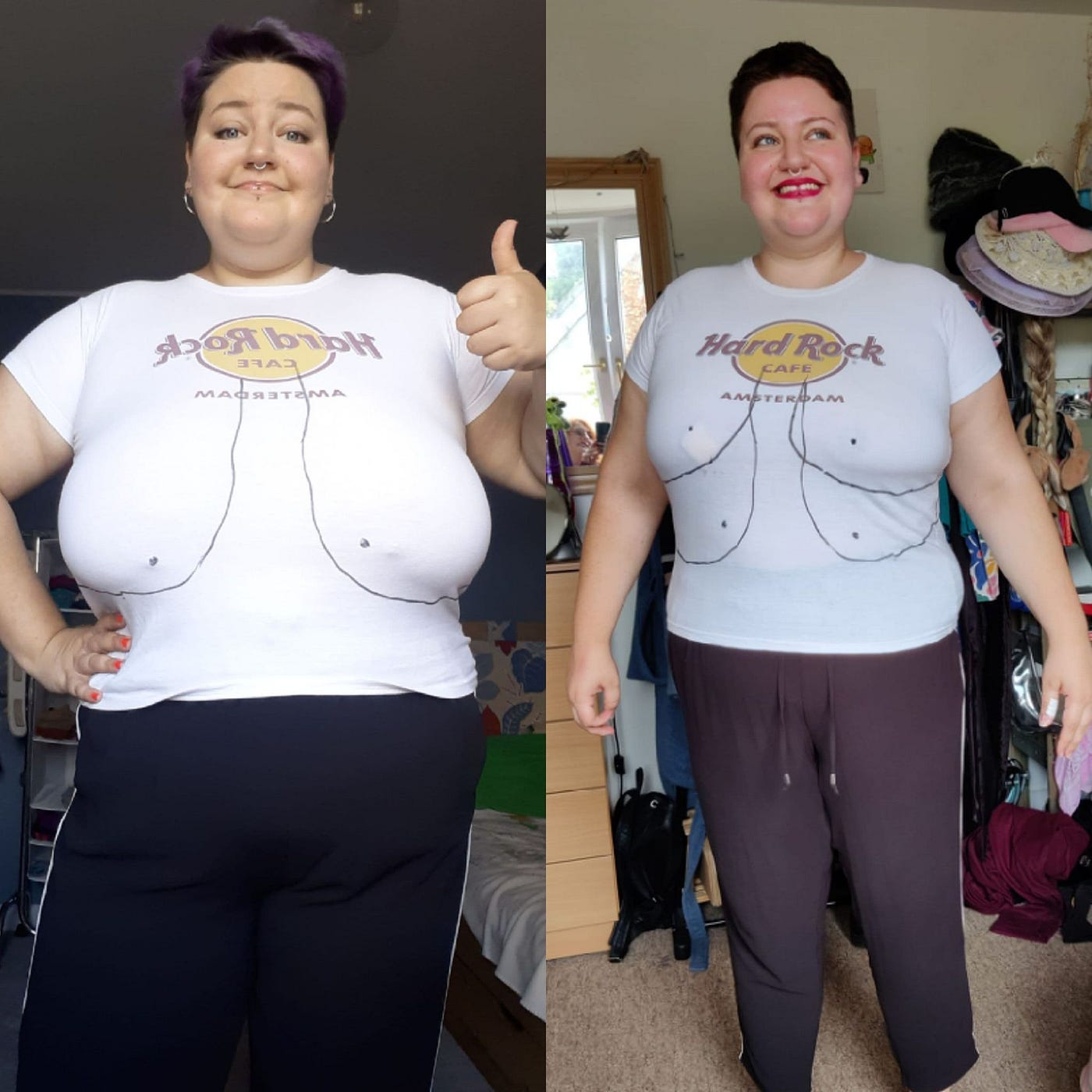 Breast Reduction Before And After In Clothes