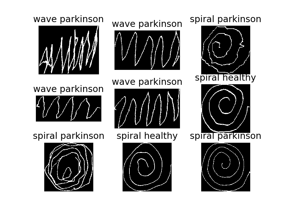 Micrographia Parkinson S Parkinson Disease Information | Mount Sinai