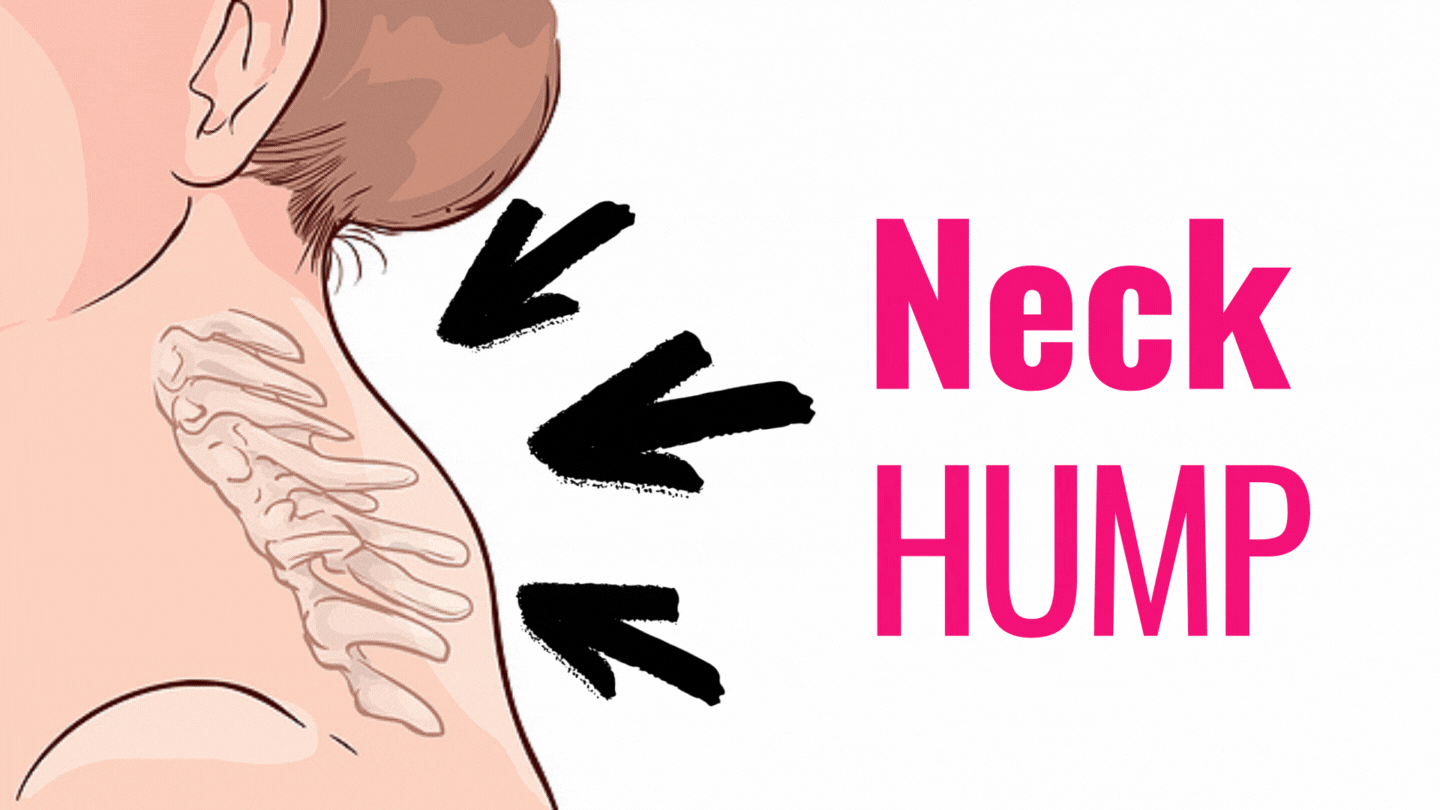 Dowagers Hump The Simple Self Care Lifestyle, 43% OFF