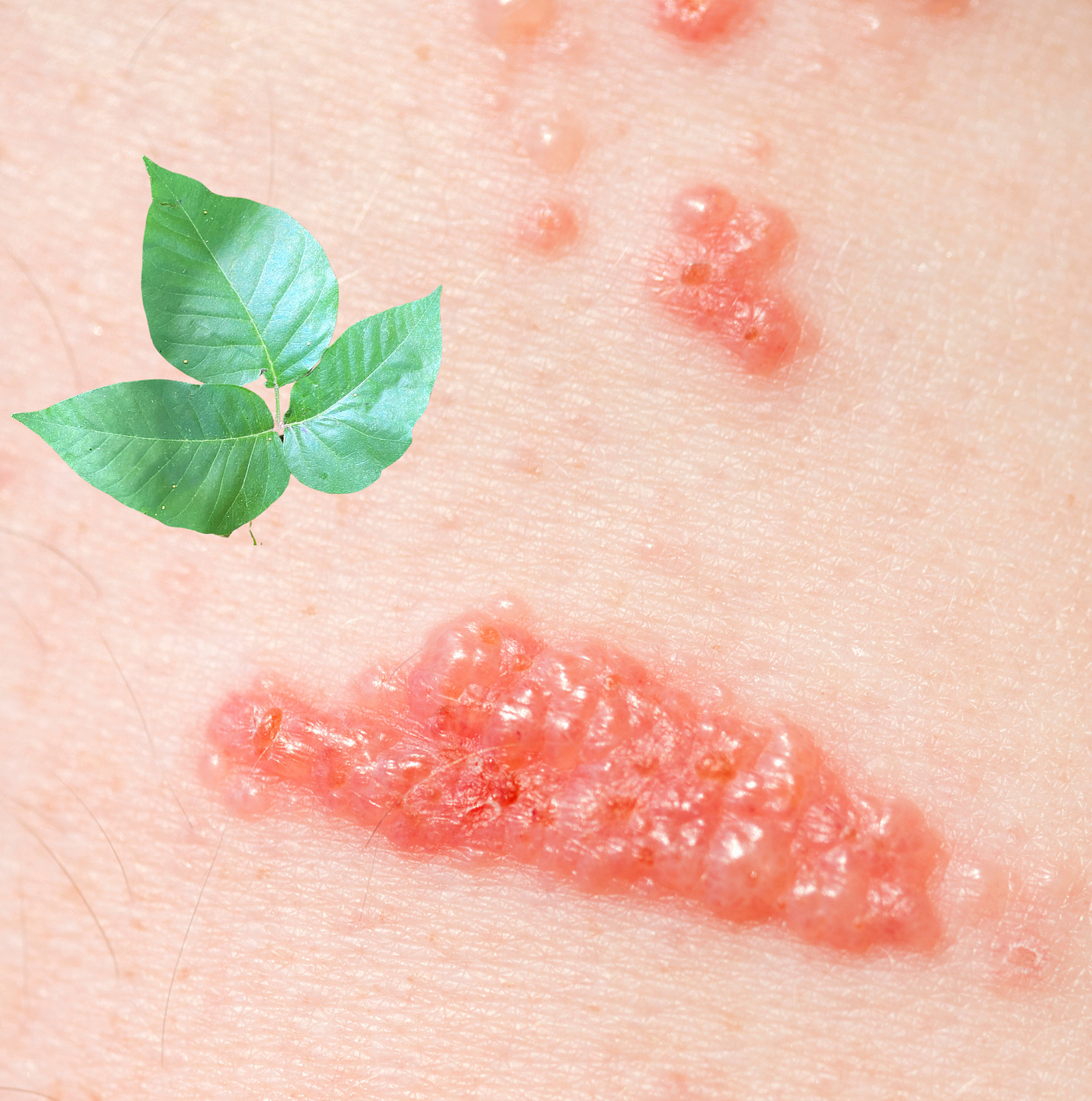 Poison Ivy Burn