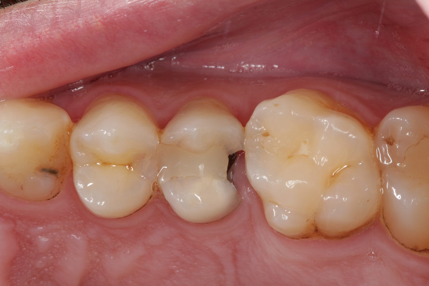 Hole In Molar No Pain