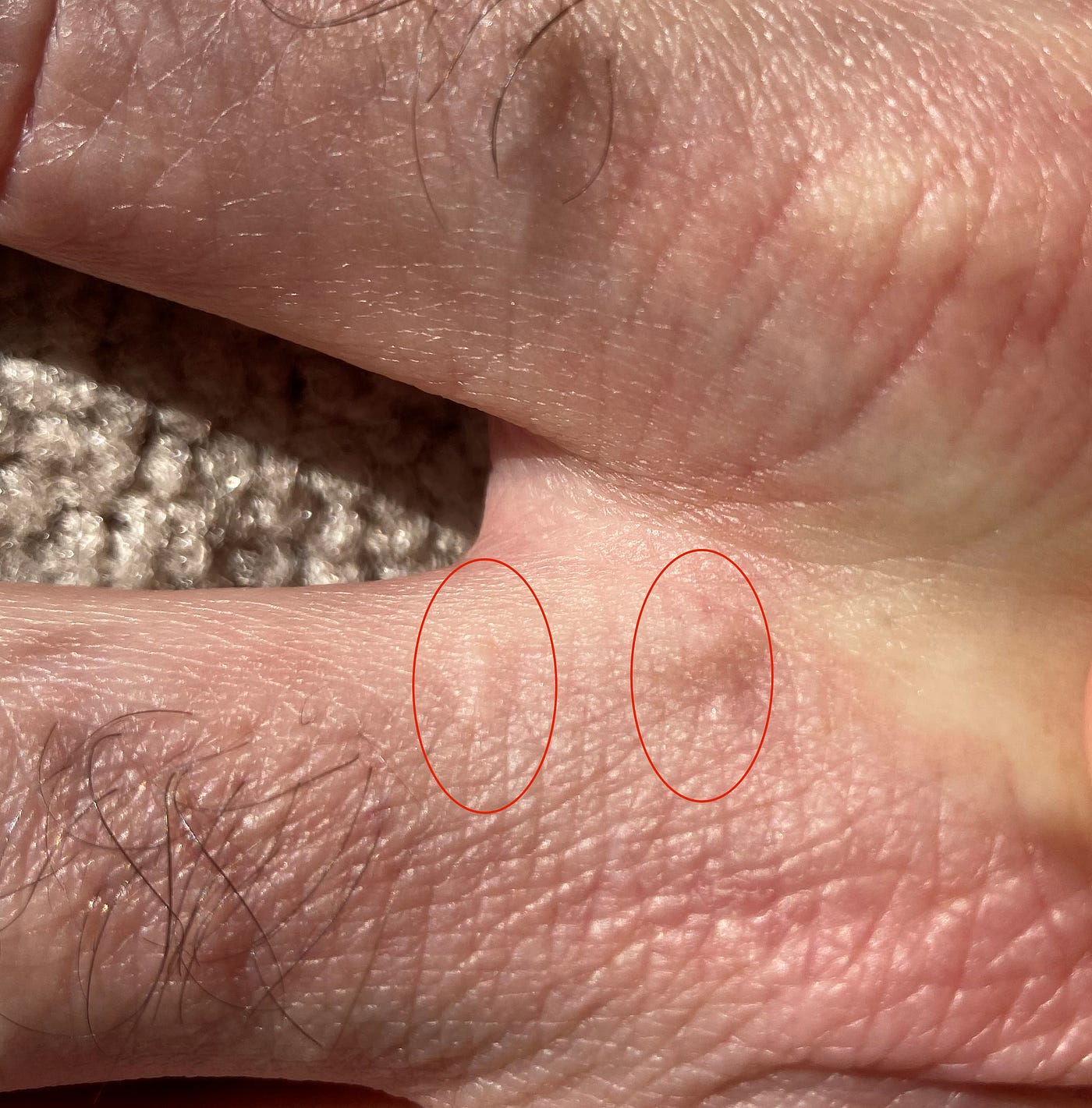 Ufo Abduction Scars