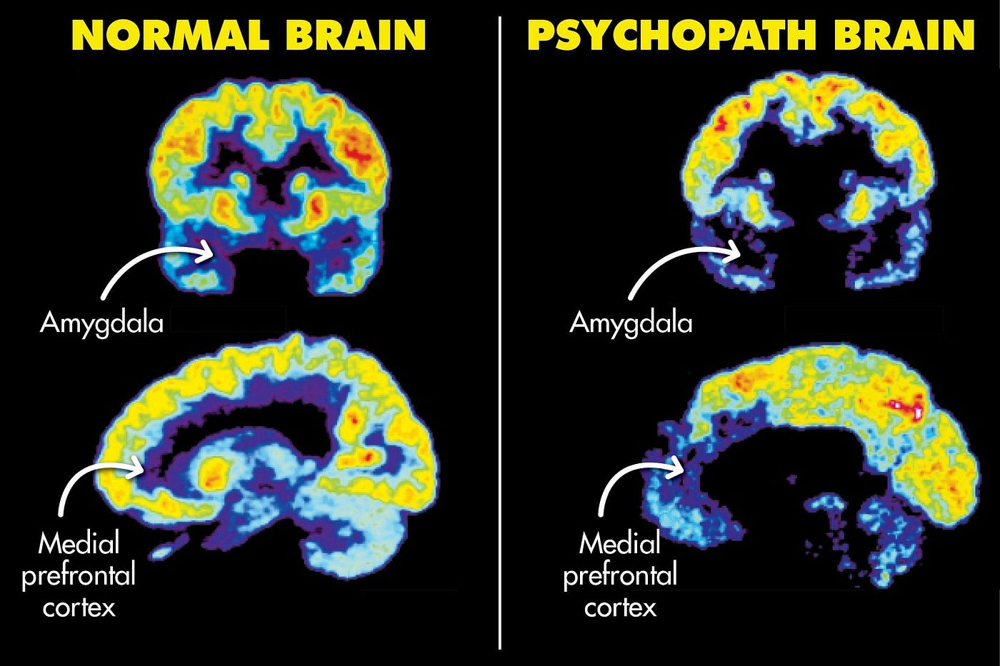 Sociopathy Brain Differences
