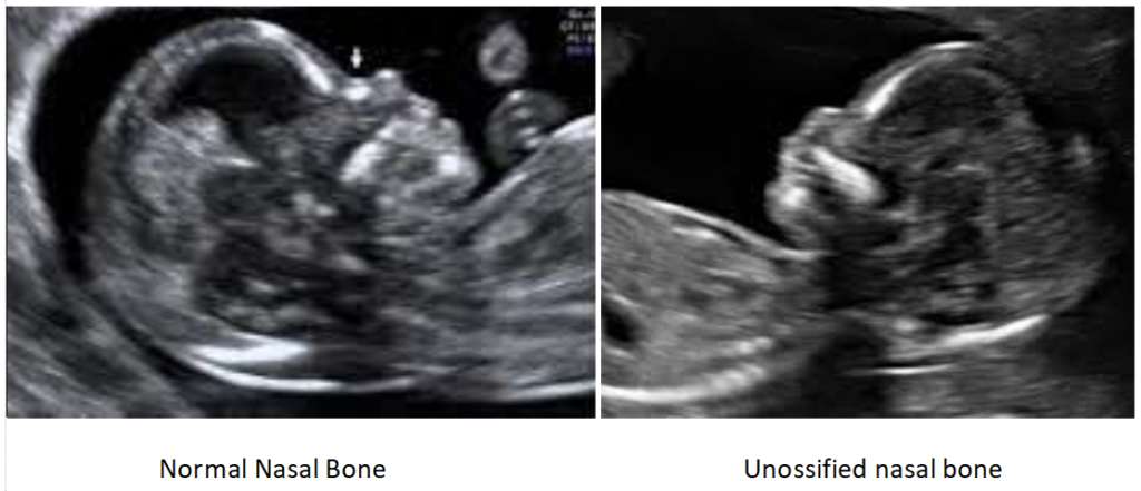 Nasal Bone Ultrasound