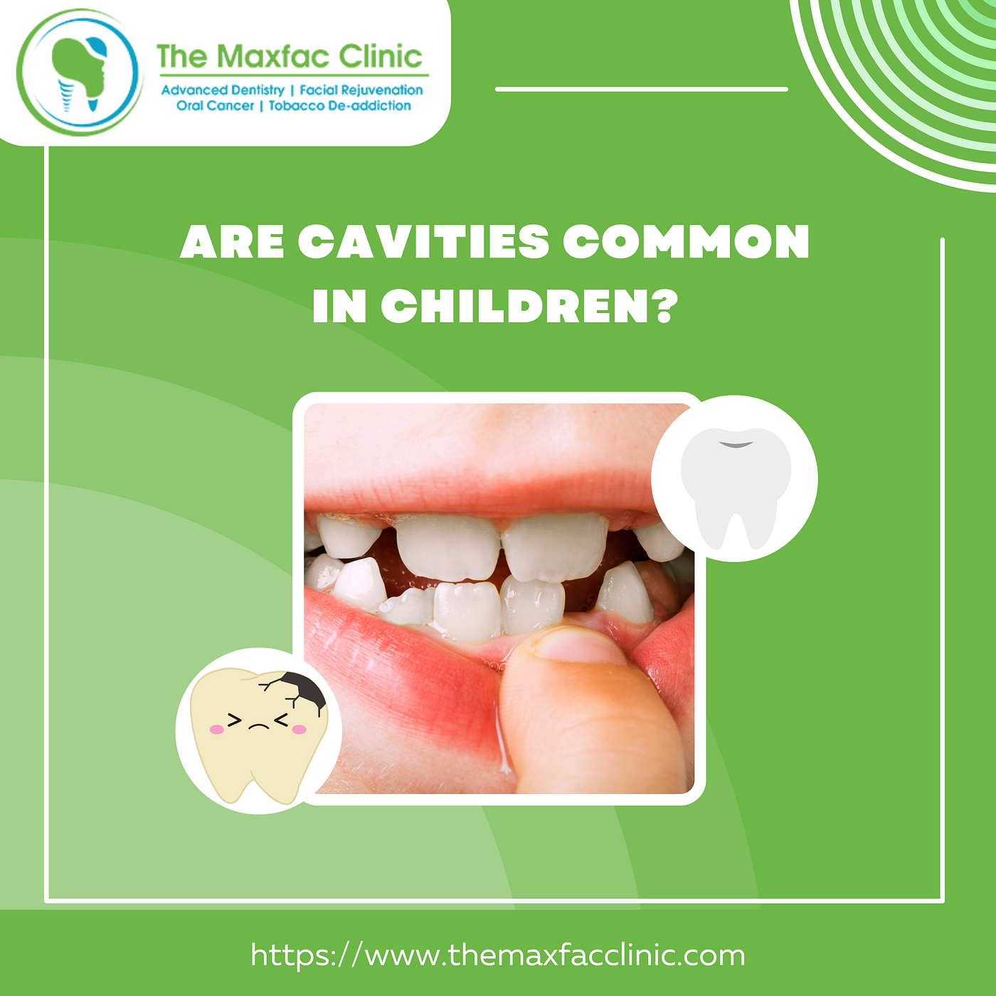 How Common Are Cavities