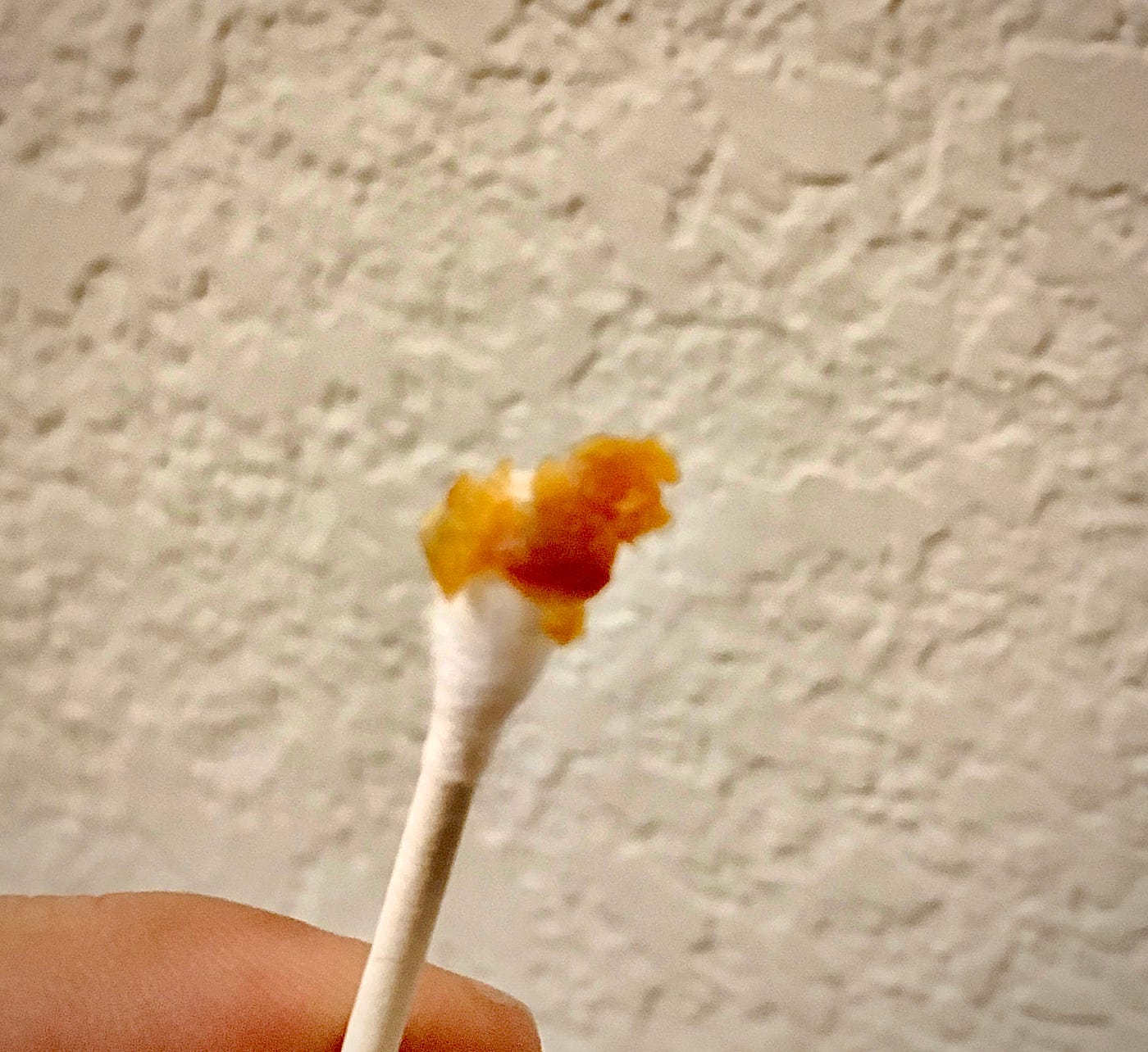 Huge Ear Wax Removal