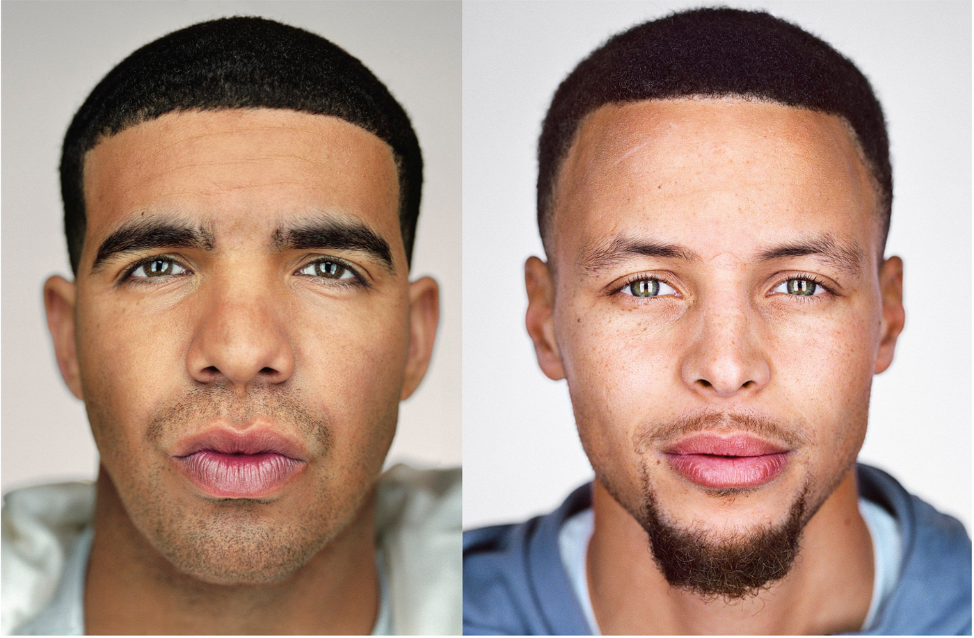 Drake Before And After Nose Job