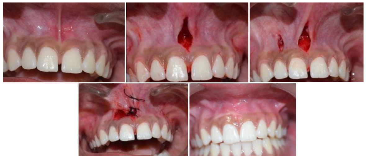 Freio Labial Remoção De Freio Labial Superior! Criança De 11 Anos
