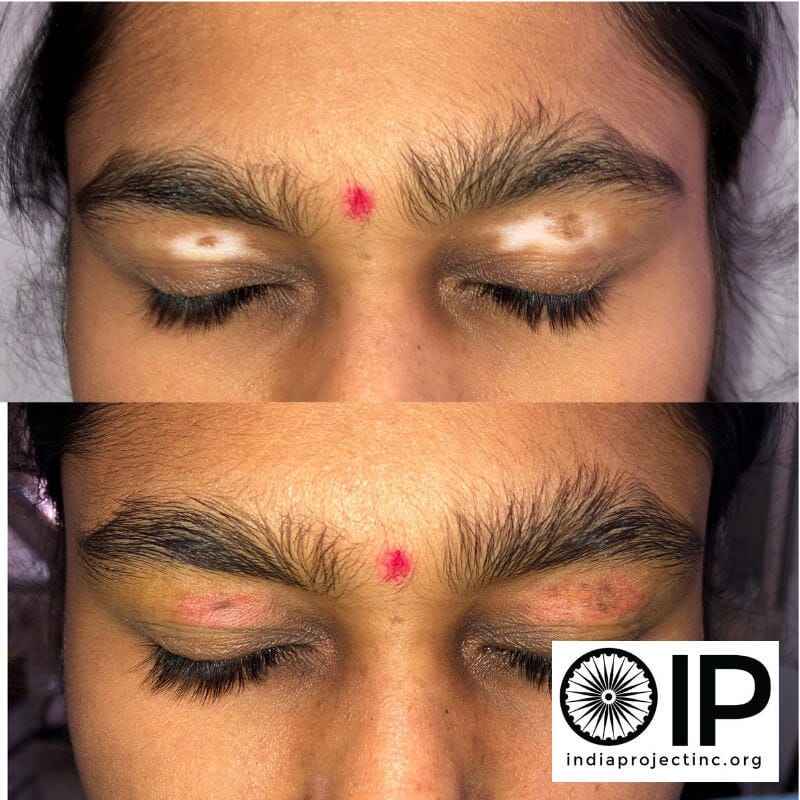 Acid Burn Victims Before And After