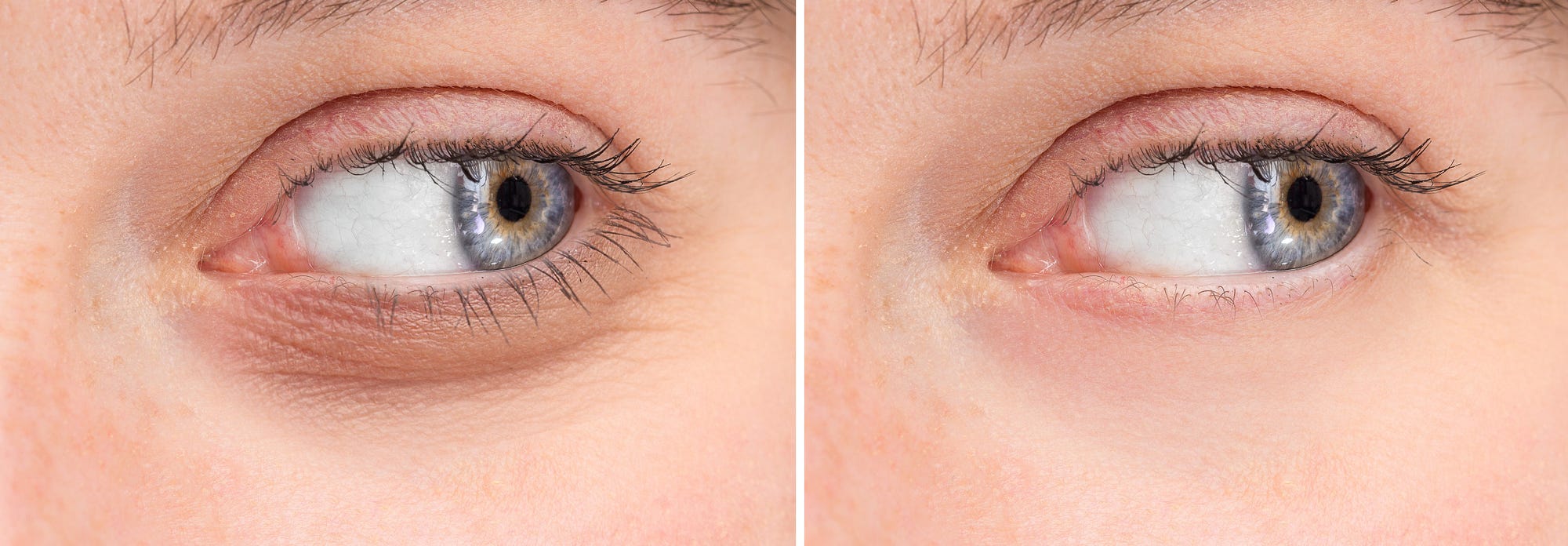 How To Get Rid Of Bags Under Eyes And Dark Circles Axe