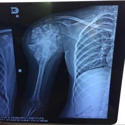 Bone Tumor Detection with YOLOv8 : Computer Vision | by Jaykumaran R | Medium