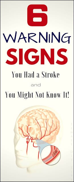 6 Signs You Had a Stroke (But You Might Not Know It!) - Nannie Welch ...